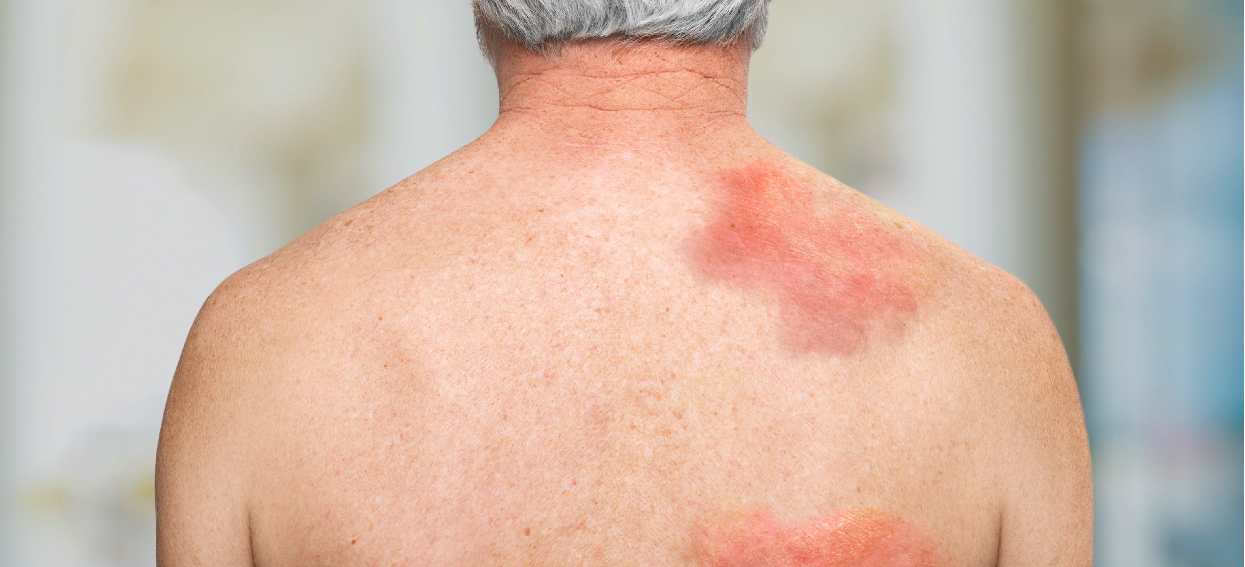 POTELIGEO® (mogamulizumab-kpkc) | Official HCP Website