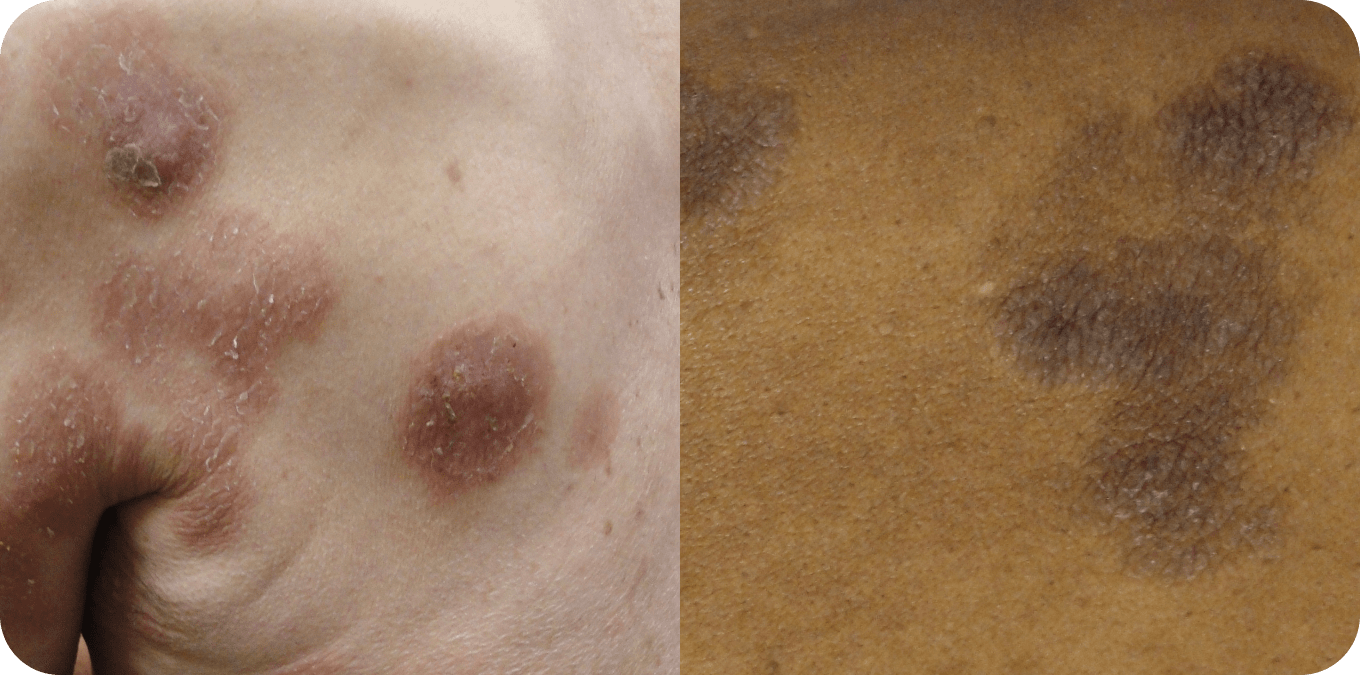 Mycosis Fungoides (MF) Identification & Treatment